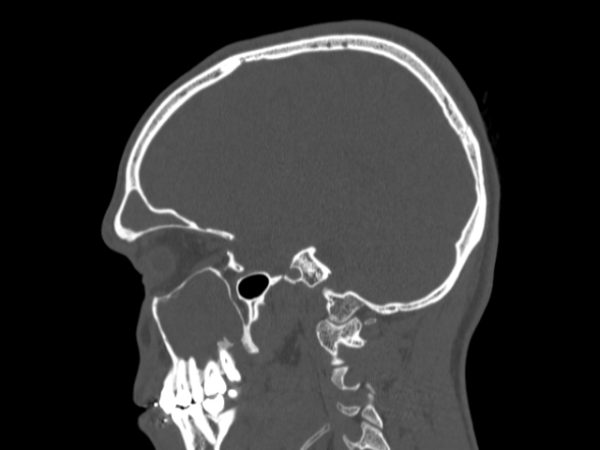 SINUSITIS ODONTOGÉNICA – RADIOLOGÍA HN